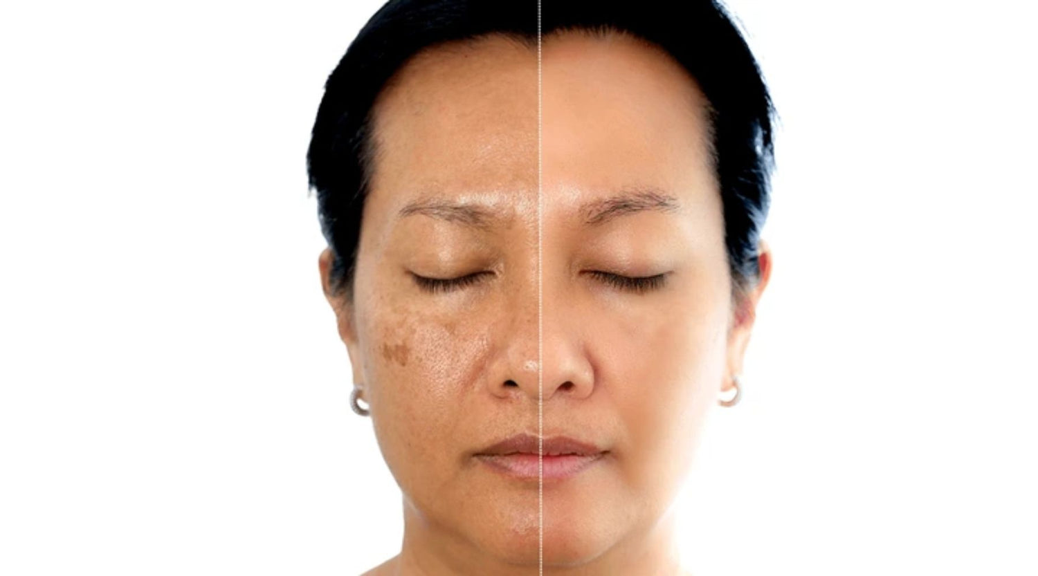 Understanding Pigmentation and Effective Skin Treatments – V 10 Plus